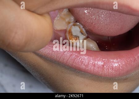 milk teeth caries, carious child teeth Stock Photo - Alamy