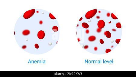 Anemia problem circulatory iron body diagram background. Anaemia ...