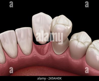 Maryland bridge made from ceramic, premolar tooth recovery. Medically ...