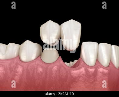 Maryland bridge made from ceramic, premolar tooth recovery. Medically ...