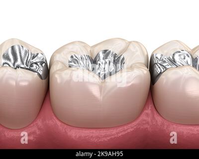 Amalgam restoration. Medically accurate 3D animation of dental concept ...