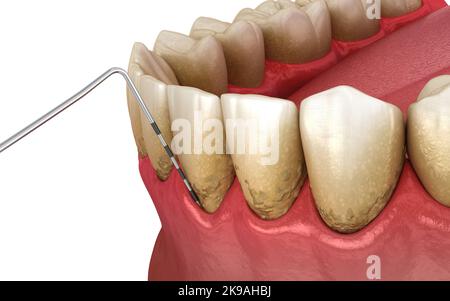 Periodontitis testing, gum recession process. Medically accurate 3D ...