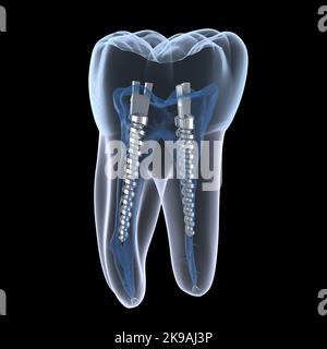 Dental steel post inside molar teeth, Xray view. Dental endodontic ...