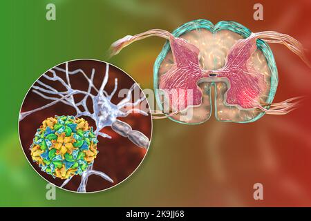 Polio viruses affecting motor neurons, illustration Stock Photo - Alamy