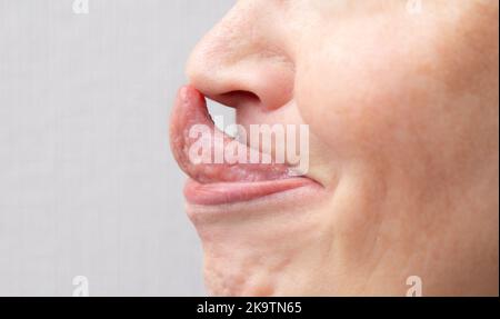 The Gorlin sign is a medical term that indicates the ability to touch ...