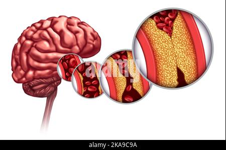 Stroke and Atherosclerosis as a Brain disorder caused by blood cells ...