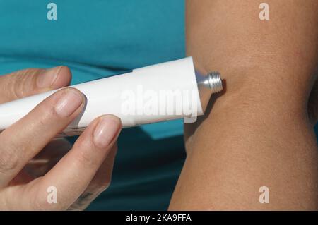 Topical pain of the elbows. Application of medical ointment on skin in ...