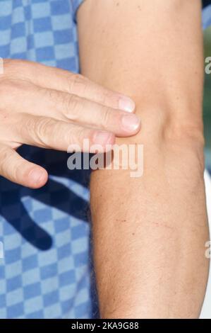 Topical pain of the elbows. Application of medical ointment on skin in ...