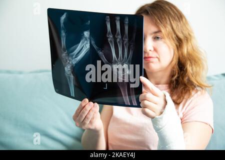 Fractured hand in cast, X-ray Stock Photo - Alamy