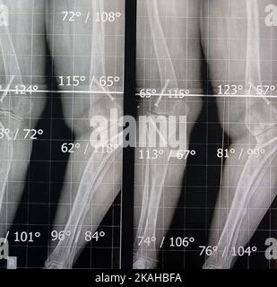 Plain x ray long film standing position showing both legs with ...