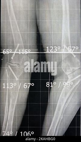 Plain x ray long film standing position showing both legs with ...