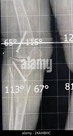 Plain x ray long film standing position showing both legs with ...