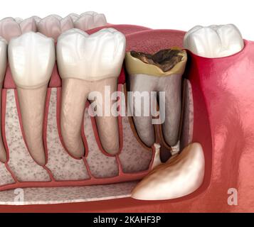 Periostitis tooth - Lump on Gum Above Tooth. Medically accurate dental ...