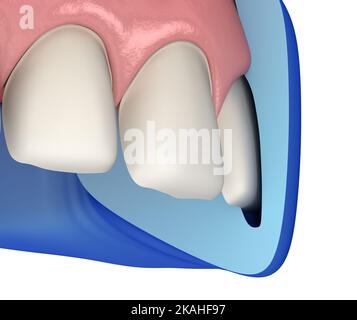 Cross-section of Mock-up dental key and prepareted incisor. Medically ...