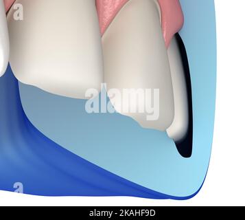 Cross-section of Mock-up dental key and prepareted incisor. Medically ...