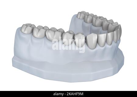 Wax-up teeth model. Treatment Planning. Medically accurate tooth 3D ...