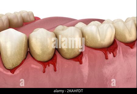 Bleeding gums or Periodontal - pathological inflammatory condition of ...