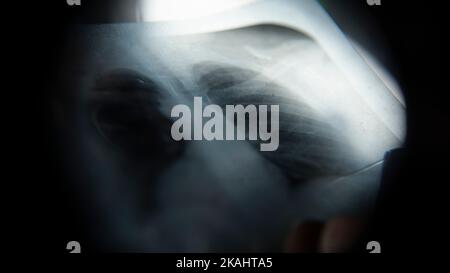 Lung x-ray extreme close-up, doctor or professor making examinations on ...