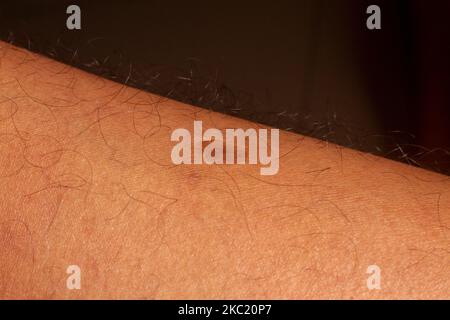 human skin texture. Flat wart on skin micro photo. close up photo Stock ...