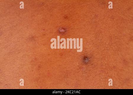 human skin texture. wart and pimples on skin micro photo. close up ...