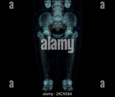 CT scan of lower extremity ,3D illustration of Femur bone , knee joint ...