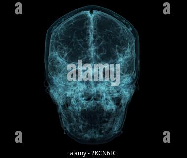 Human Skull, Brain by CT Scan. X-ray Visualization Inside Of Skull. 3D ...