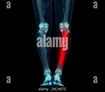 3D render of lower extremity or legs isolated on black background Stock ...