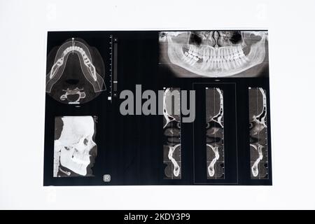 A patient with malocclusion, missing chewing tooth and ...