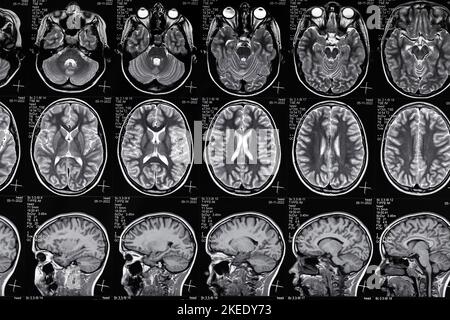 High resolution magnetic resonance image scan of brain epi syndrome ...
