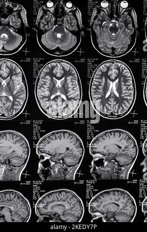 High resolution magnetic resonance image scan of brain epi syndrome ...