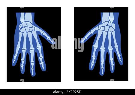 Human palm xray. Hand bones anatomy illustration Stock Vector Image ...