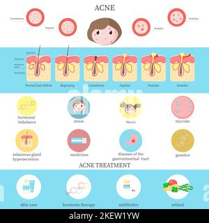 Acne causes and treatment diagram, vector flat style design ...
