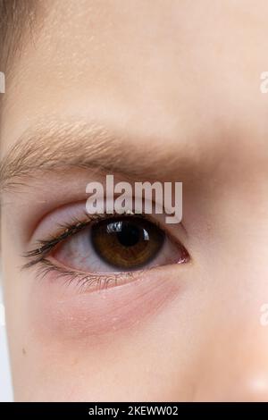 Child with swollen pink eye. Eyes infection and pollen allergy ...