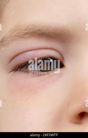 Eye of a child with conjunctivitis, inflammation of the conjunctiva ...