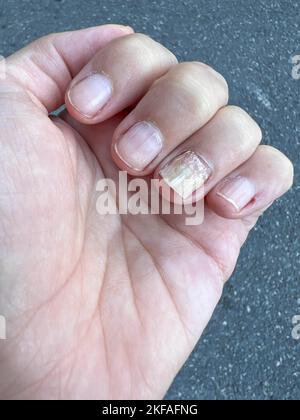 Fungal nail infection on the fingers of the hand of an adult patient ...