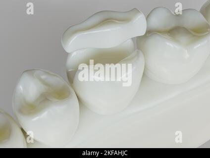 Ceramic Overlay crown over a tooth- 3D Rendering Stock Photo - Alamy