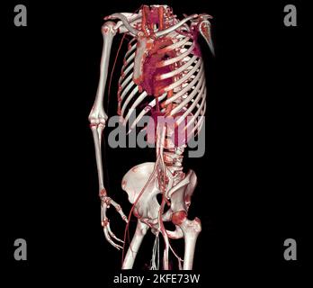 CTA brachial artery or CT scan of upper extremity 3D rendering image ...