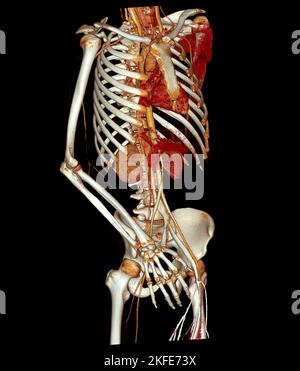 CTA brachial artery or CT scan of upper extremity 3D rendering image ...
