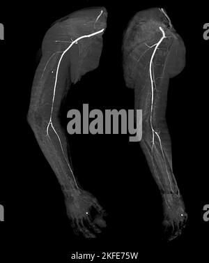 CTA brachial artery or CT scan of upper extremity 3D rendering image ...
