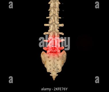 CT scan of Lumbar spine 3D rendering showing Profile Human Spine ...