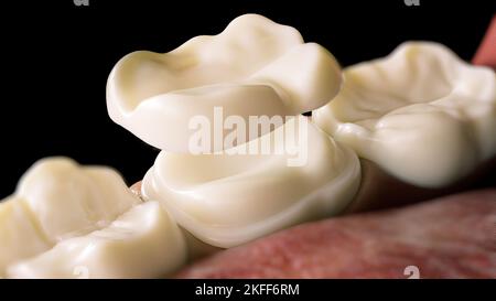 Ceramic Inlay crown over a tooth- 3D Rendering Stock Photo - Alamy