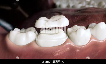 Ceramic Overlay crown over a tooth- 3D Rendering Stock Photo - Alamy