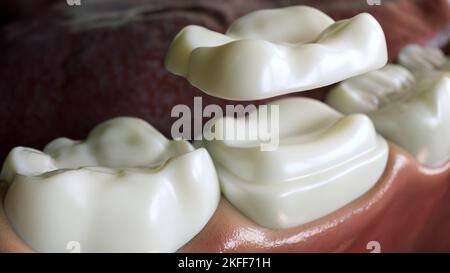 Ceramic Overlay crown over a tooth- 3D Rendering Stock Photo - Alamy