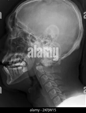 Dislocation of the cervical vertebrae Stock Photo - Alamy