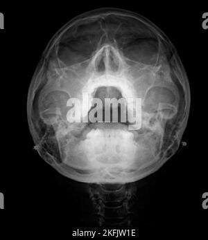 Radiography of a human skull paranasal sinuses rhinosinusitis ...