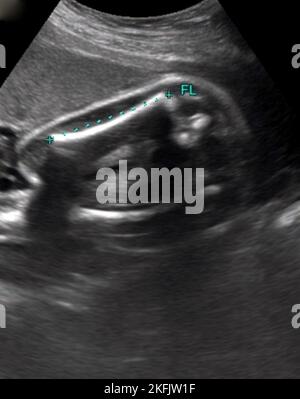 Foetal measurement, ultrasound scan Stock Photo - Alamy