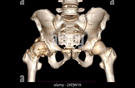 Osteoarthritis of the hip, 3D CT scan Stock Photo - Alamy
