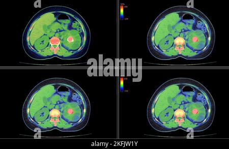 Kidney stone. Coloured abdominal X-ray showing a kidney stone (white ...