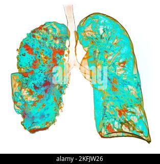 Pneumonia. Coloured computed tomography (CT) scan of an axial section ...