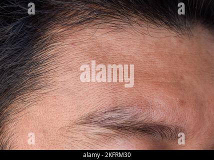 Skin creases or wrinkles at the forehead of Southeast Asian, Myanmar or ...